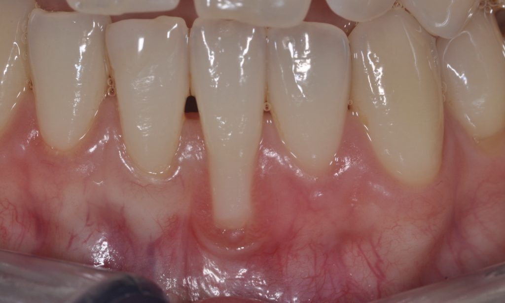 Periodontal Plastic Surgery - Specialist Implant Clinic